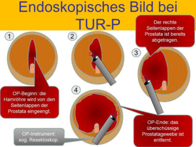 Therapie der gutartigen Prostatavergößerung (medikamentös / TUR-P ...